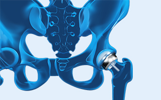 Knee Replacement Darlinghurst | Hip Resurfacing Bella Vista
