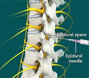 Epidural Spinal Injection Houston | Back Pain Treatment | Herniated ...
