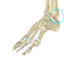 Ankle Impingement Visalia, CA | Anterior Ankle Impingement Fresno, CA