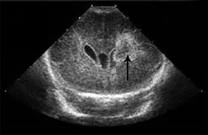 IVH Prematurity – Intraventricular Hemorrhage in Premature Infants | Dr ...