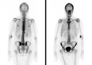 Bone Scan New York City NY | Diagnostic Imaging New York City
