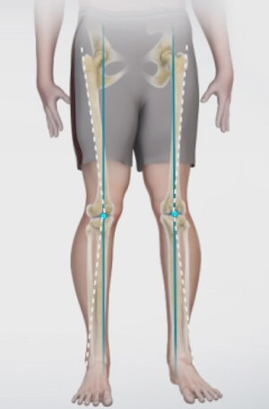 Knock Knees Treatment New York City NY | Angular Knee Deformity New ...