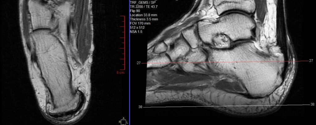 MIS Haglund Resection with Speedbridge Repair – walking at 2 weeks San ...