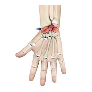 Hand & Wrist Conditions | Elite Ortho Sport Spine, Orthopaedic Surgeon Manchester