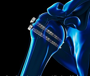 Hip Labral Repair San Diego CA | Hip Arthroscopy Orange County, La Jolla