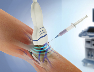 Ultrasound Guided Injections Birmingham | Joint Disorder Northampton ...