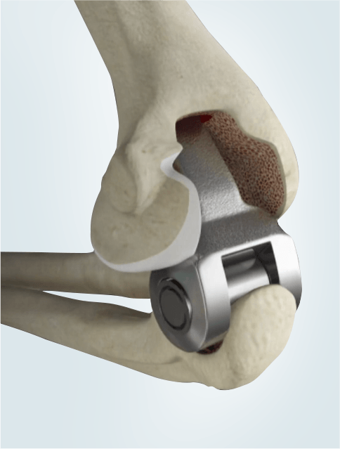 Total Elbow Replacement East Greenwich | Elbow Arthritis | Elbow ...