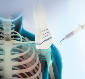 Ultrasound-Guided Shoulder Injections Miami | Shoulder Joint Injection ...