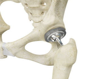 Total Hip Replacement Surgeon Santa Ana, CA | Hip Arthritis Orange, CA