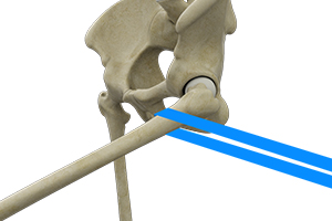 Hip Surgeons Milwaukie | Hip Surgery Gresham, Multnomah County ...