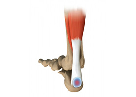 Achilles Tendon Bursitis Rexburg ID | Achilles Tendon Rupture Rexburg ID